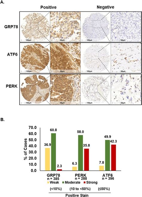 Immunohistochemical Expression Patterns Of Er Stress Associated