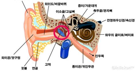 귀 후비다 악~ 생각보다 흔한 고막파열