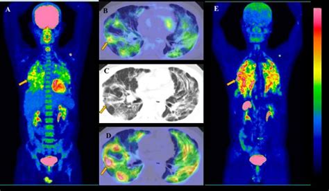 Male 46 Years Old With Iip F [image] Eurekalert Science News Releases