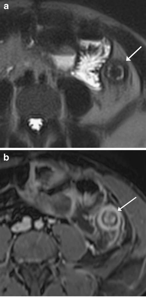Patient With Active Distal Colitis A Axial Haste Image Shows Very High