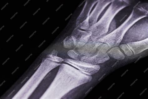 Premium Photo Xray Of The Hands Detail Of The Phalanges And