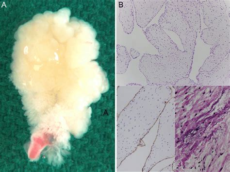 A Gross Examination Of The Tissue Revealed A Myxoid Appearance With Download Scientific