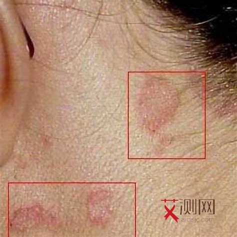 艾滋病皮肤前兆症状图片大全高清图艾滋病症状艾测网