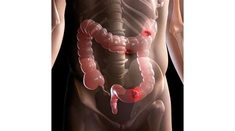 Small Bowel Follow Through An X Ray Procedure To Examine The Small