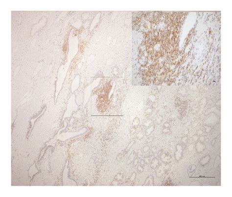 Photomicrograph Of Immunohistochemical Staining For Cd44 In Stromal