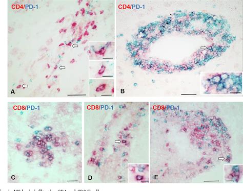 Ebv Infected Cells In The Multiple Sclerosis Brain Express Pd L1 How