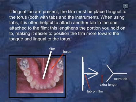 Radiology Bitewing Technique