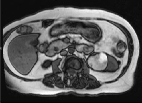 A Pre Gadonlium Fat Saturated 3d Gradient Echo Sequence Demonstrating