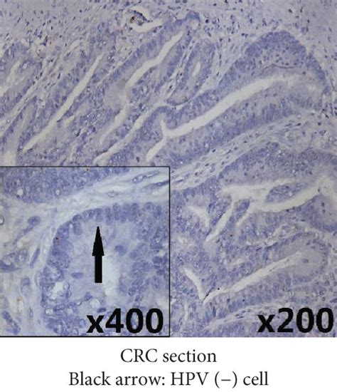 Distribution Of HPV Viral Antigen In CRC Tumor Tissue And Adjacent