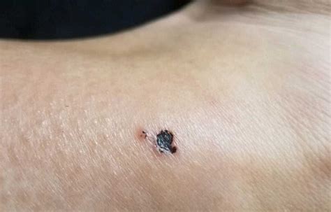 Image Of The Week Glossy Black Macule On The Ankle Clinical Advisor