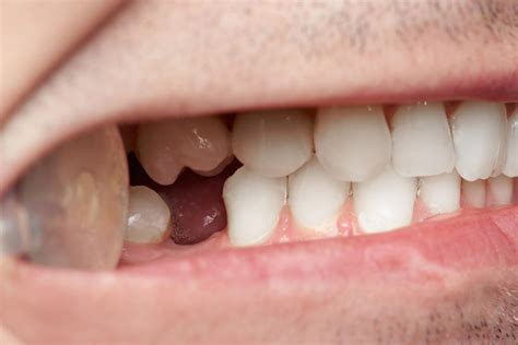 Three Surprising Ways Missing Teeth Affect Your Health