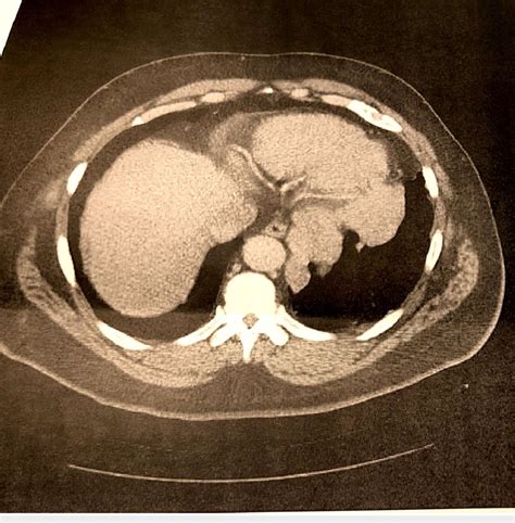Ct Abdomen And Pelvis Wcontrast Multiple Left Lower Masses Are Seen