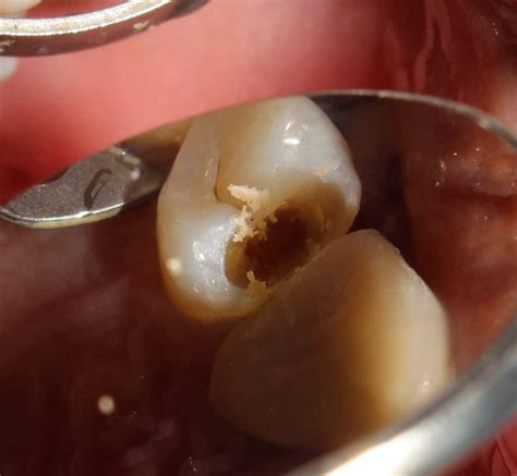 Deep Class 2 Caries Management Myzerodonto