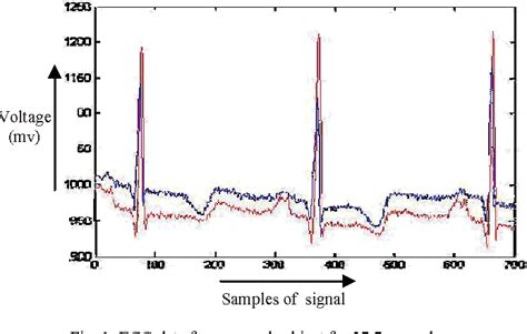 Figure 1 From Arrhythmia Detection Based On Derivative Analysis Of Qrs Complex Semantic Scholar