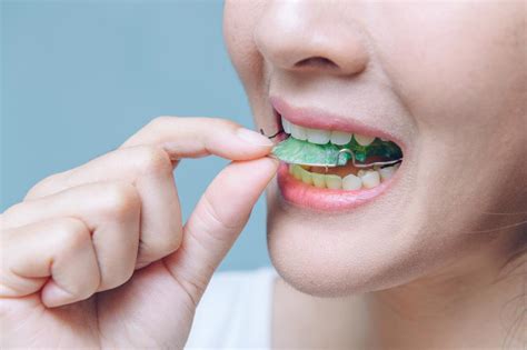 The Importance Of Retainers Post Braces Key Benefits