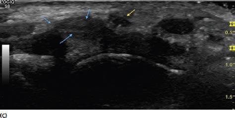 Specular Reflection Ultrasound