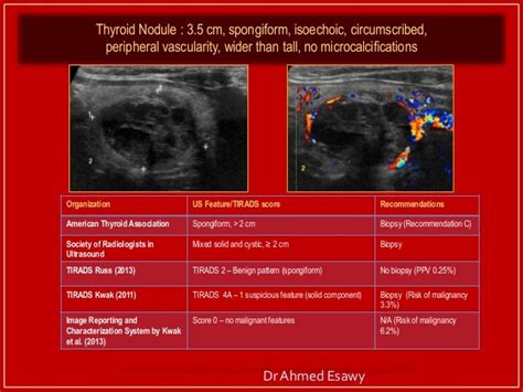 Tirads Thyroid Nodule Imaging Reporting And Data System Dr Ahmed E