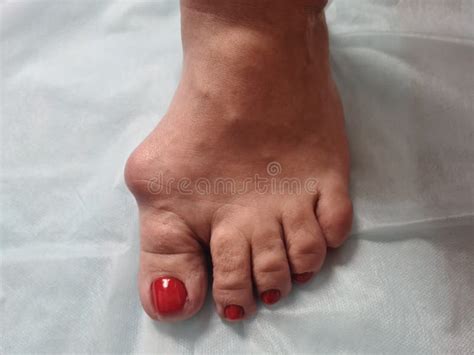 Woman Suffers From Inflammation Of Big Toe Bone Stock Image Image Of Sticking Hallux 263009215