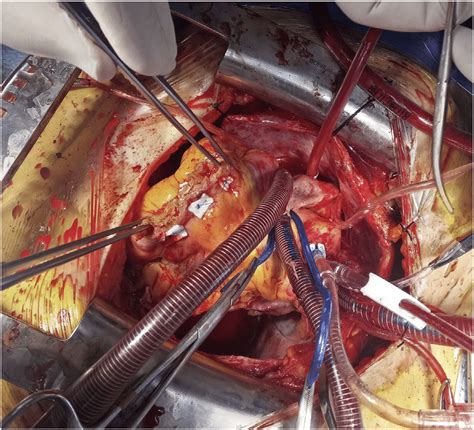 Closure Of Hydatid Cyst Cavity By Pledgeted Sutures Download