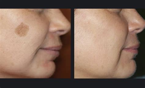 دستگاه لیزر Gentlemax Pro Plus کندلا 2024 نمایندگی کندلا