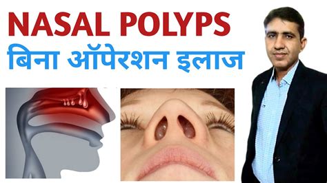 Nasal Polyps Removal Symptoms Diagnosis And Treatment