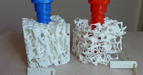 Trabecular Bone Osteoporosis Model With Bone Screw By Akimakes Download Free Stl Model