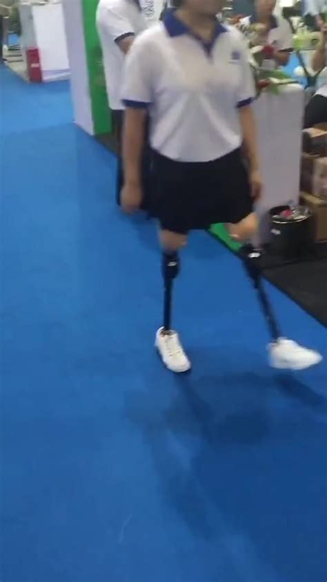 Dak Woman Practice Walking With Prosthetics 2