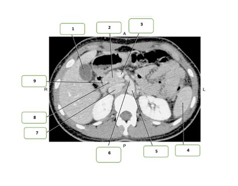 Abdomen And Pelvis Anatomy Ct 4 Quiz