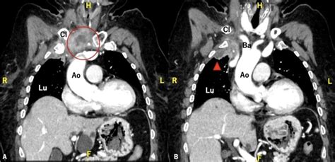 Mediastinal Abscess In An Immunocompromised Patient Which Progressed