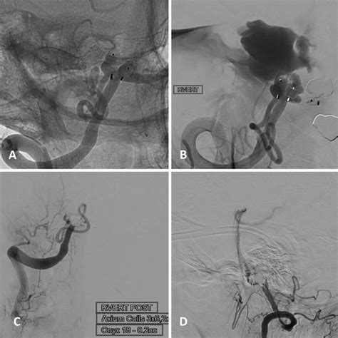 The Woven Endobridge Web Device Feasibility Techniques And Outcomes After Fda Approval In