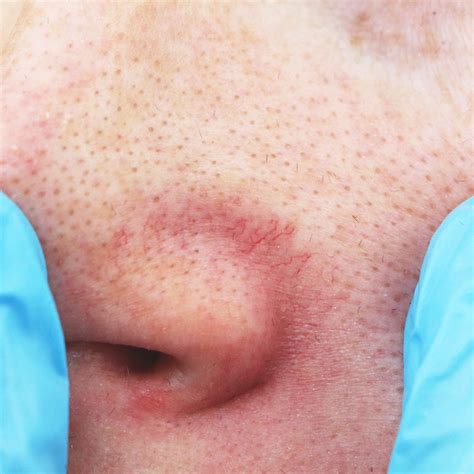 성신여대입구역 피부과 포이즌의원 추운 날씨에 심해지는 안면홍조 치료 성신여대 포이즌 피부칼럼 성신여대피부과 포이즌의원