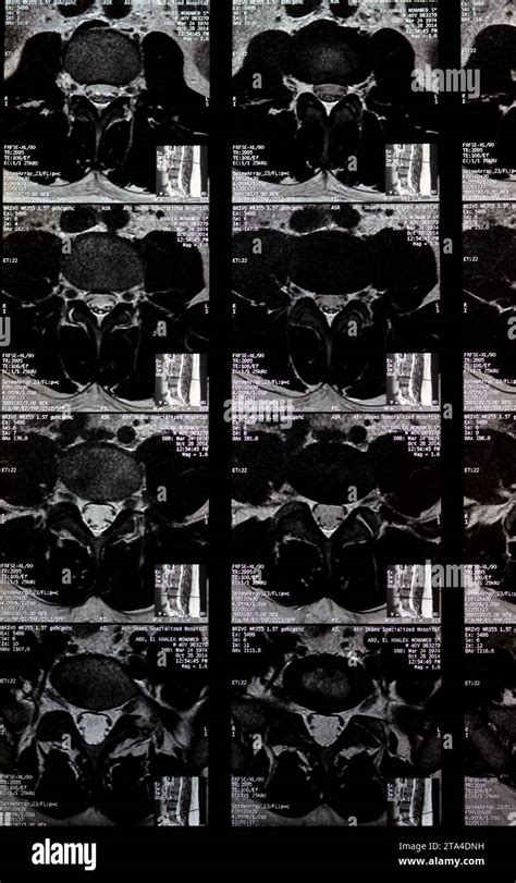 Cairo Egypt November 14 2023 Mri Of Lumbosacral Spine Revealed