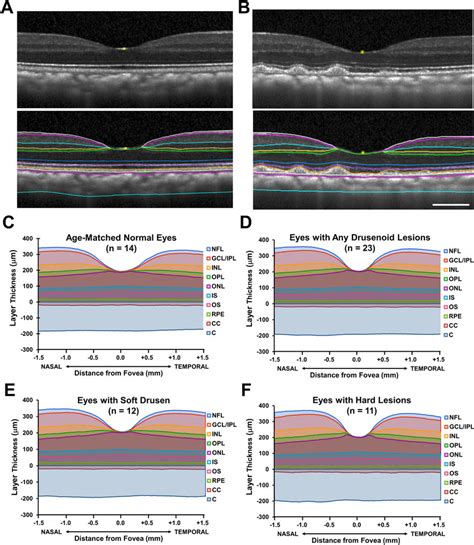 image segmentation and thickness measurement of retinal and choroidal download scientific
