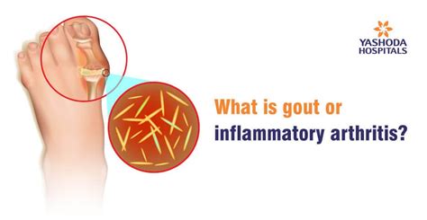 Viral Arthritis Causes Symptoms Risk Factors And Treatment