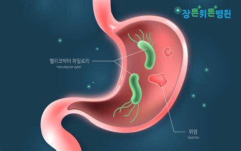 헬리코박터 제균치료 방법과 주의사항 네이버 포스트