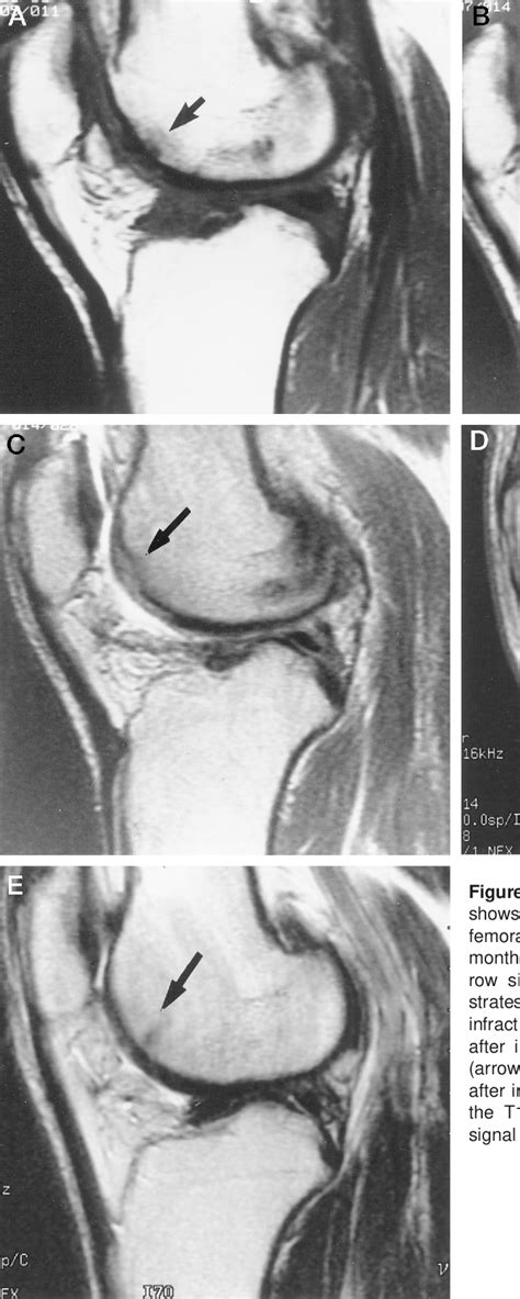 Figure 1 From Occult Osteochondral Lesions After Anterior Cruciate