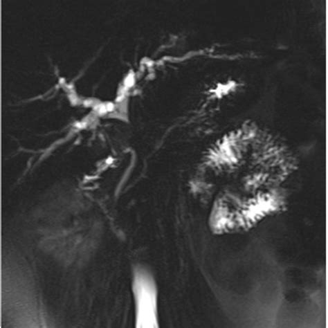A Stricture Just Distal To The Common Hepatic Duct Confluence And