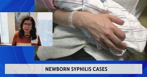 Syphilis Cases In Newborns On The Rise Cbs San Francisco