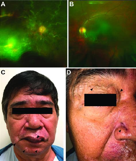 Imaging Of The Fundus Demonstrating An Abnormal Vascular Structure Of Download Scientific