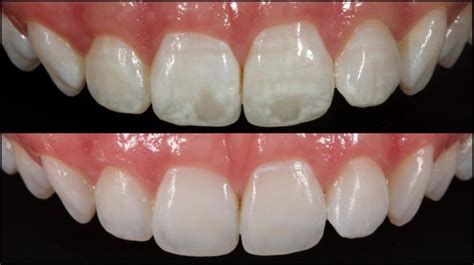 Enamel Microabrasion Helix Dental