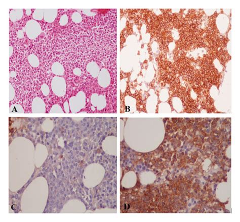 Bone Marrow Shows Sheets Of Plasmacytoid Cells A Hande B Cd138 C
