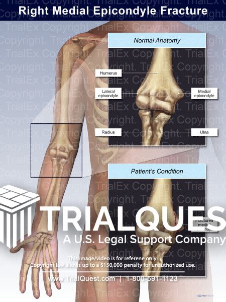 Right Medial Epicondyle Fracture Trial Exhibits Inc