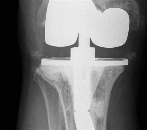 Management Bone Defects The Bone School