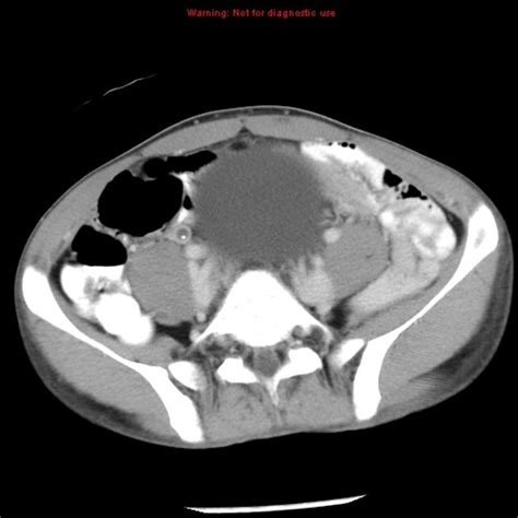 Appendicitis Ct Radiopaedia If Left Untreated Appendicitis May Cause