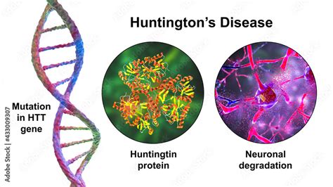 Huntingtons Disease Aurora Health Care