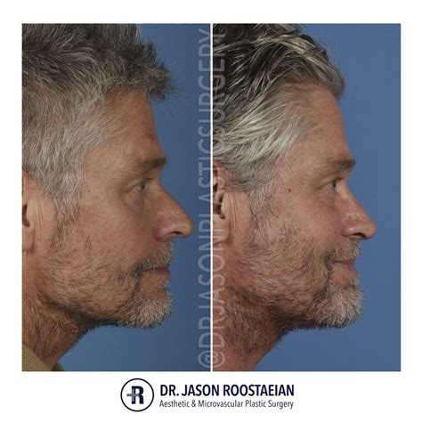 Plastic Surgery Before And After Nose Men