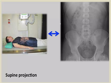 Presentation1 Interpretation Of X Ray Of The Abdomen Pptx