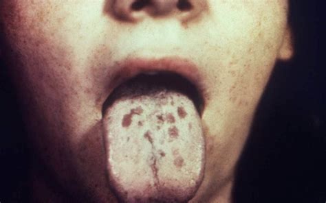 Spike In Syphilis Cases Practising Safe Sex And Testing Crucial Ministry Says Rnz News