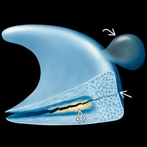 Parameniscal Cyst Radiology Key