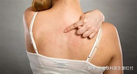前胸后背长痘，是痤疮还是毛囊炎？ 知乎